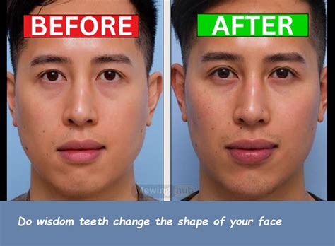 Wisdom Teeth Before And After 5 Things You Will Want To Know Before