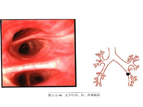 纤支镜图谱ppt【最经典纤维支气管镜图谱】word文档在线阅读与下载无忧文档