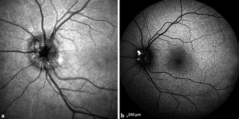 Fundus Imaging Of Optic Disc Drusen Odd In A 22 Year Old Healthy