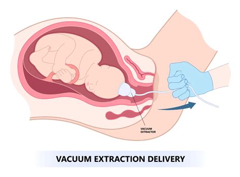 Vaginal Delivery Dr Claudia Chi