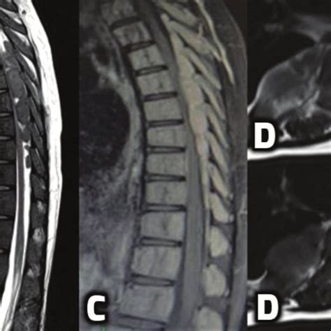 A T1 Weighted Sagittal Section Of Thoracic Spine Showing A Large