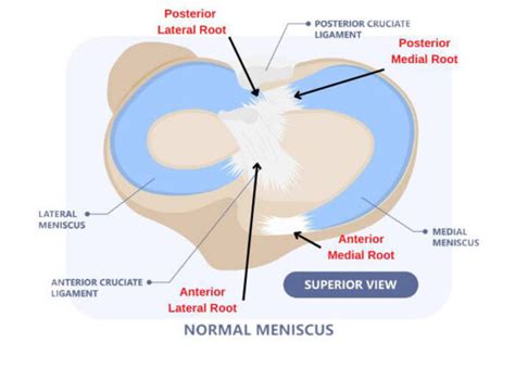 Meniscus Root Repair Knee Doctor Sugar Land Pearland Houston Tx