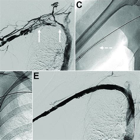 Pdf Percutaneous Thrombectomy Of Upper Extremity And Thoracic Central