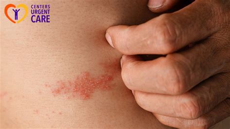 Wellness Tips From Josef Schenker Md Treating Shingles Centers Urgent Care