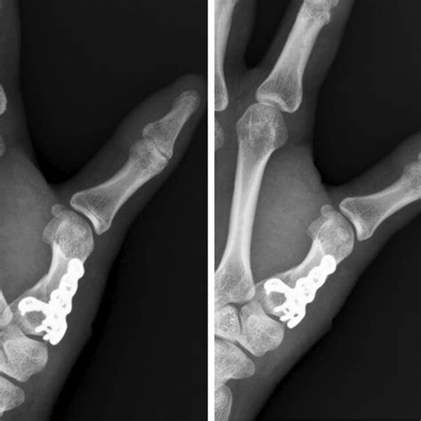 Pod 20 Orif With A Hook Embracing Plate With Excellent Radiologic Download Scientific Diagram
