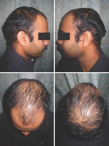 Androgenetic Alopecia Global Assessment Download Scientific Diagram