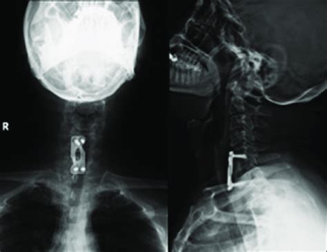 Plain Radiographs Showing C6 Corpectomy With C5 C7 Fusion And Anterior Download Scientific