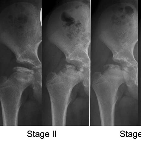 The Prevalence Of Acetabular Retroversion During The Course Of The Download Scientific Diagram
