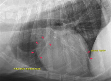 Rad Healed But Recurrent Aspiration Pneumonia With Chronic Airway