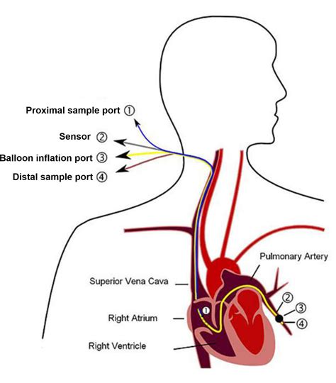 Clinical Pulmonary Artery Catheter