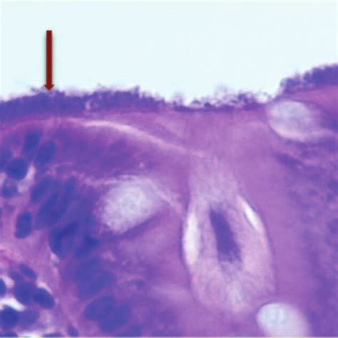 Warthin Starry Silver Stain Demonstrating The Multitude Of Spirochetes