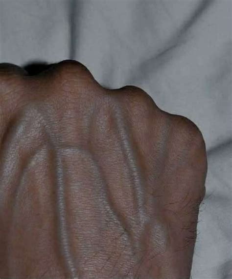 Visible Veins Explained Normal Causes Health Risks And When To Worry