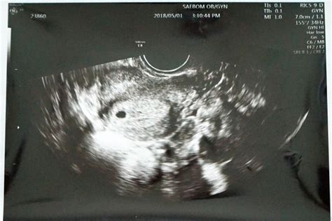 임신초기 증상부터 임신 피검사 비용 피검수치 아기집확인까지 네이버 블로그