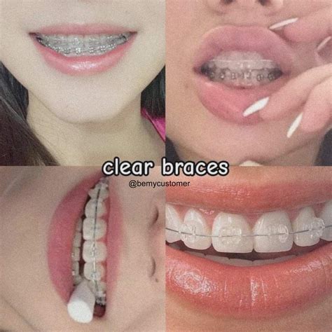 「braces 😬」おしゃれまとめの人気アイデア｜pinterest｜kahlia Meehan 歯列矯正 ロールモデル 歯