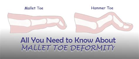 All You Need To Know About Mallet Toe Deformity
