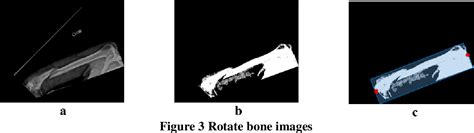 Figure 1 From Design Of A Fracture Detection System Based On Deep