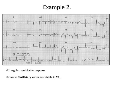Atrial Fib Flutter PPTX Heart And Cardiovascular Diseases Diseases And Conditions