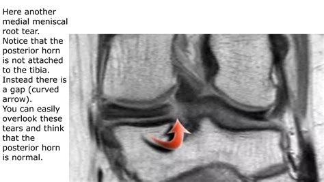 Meniscus Meniscal Root Ligament Lesions Mri Of Pmmrl Tears Posterior