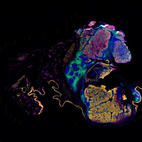 Spatial Biology A World First Study Arutha Kulasinghe Posted On The Topic Linkedin