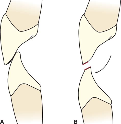 arch traits that differentiate mandibular from maxillary incisors