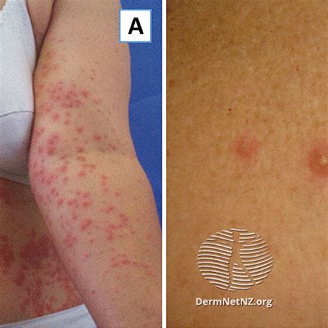 Pyoderma Gangrenosum A A Violaceous Plaque With An Erythematous Border