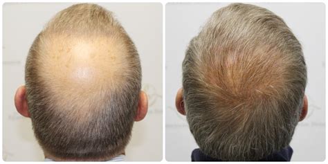 Dr Bonaros Glasgow Uk 3102 Fue Grafts 0 12 Months Hair Loss