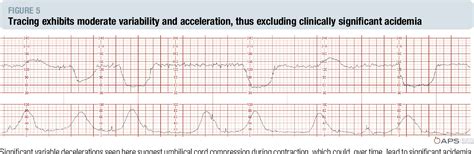 Figure 5 From Intrapartum Management Of Category Ii Fetal Heart Rate
