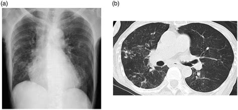 Imaging Findings A Chest X Ray Revealed Multiple Small Nodular Download Scientific Diagram