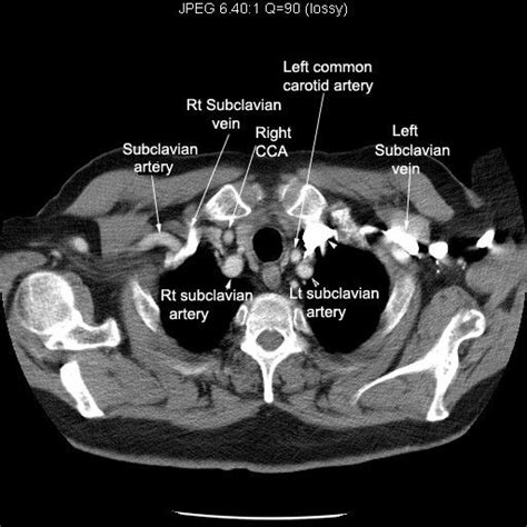 Ct Anatomy Of Common Carotid Artery At Myrtle Garza Blog