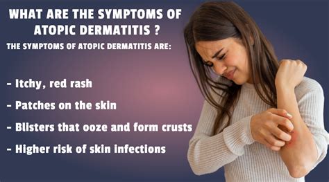 Atopic Dermatitis Treatment Symptoms Of Atopic Dermatitis What