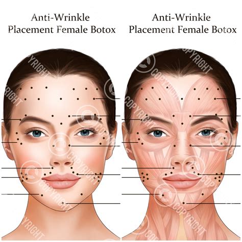 Botox Injection Points Bundle Botox And Filler Injector Anatomy Art