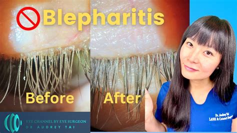 Best Blepharitis Treatments At Home Simple And Effective Step By Step Guide Eye Surgeon