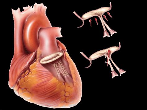Valve Defects Edwards Lifesciences