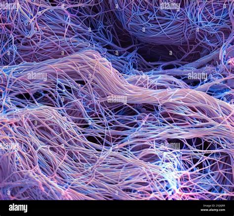 Connective Tissue Coloured Scanning Electron Micrograph Sem Of Collagen From A Nasal Poly