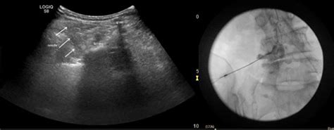 Feasibility Of Ultrasound Guided Lumbar Transforaminal Epidural Steroi