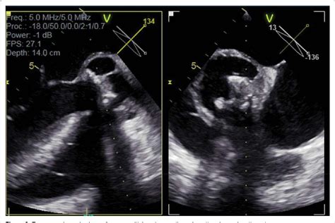 Figure 3 From A Rare Case Of Vagococcus Fluvialis Prosthetic Valve Endocarditis And Aortic Root