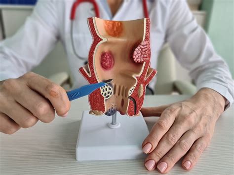 Conheça O Proctologista Médico Que Trata Hemorroidas E Outras Doenças Varicell