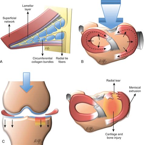 Imaging Of The Meniscus Clinical Tree