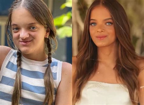 Rafa Justus Veja O Antes E Depois De Rinoplastia