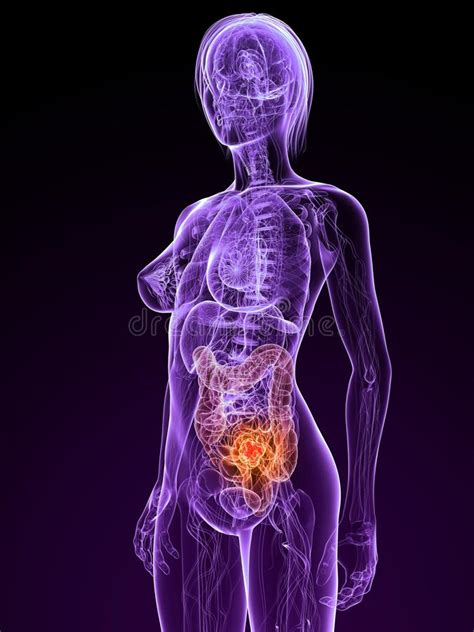 Colon Cancer Stock Illustration Illustration Of Gallbladder