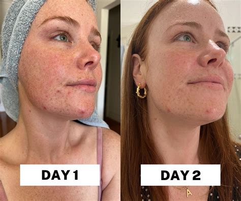 The Ordinarys Discontinued Salicylic Acid Serum Is Back And We Have Thoughts