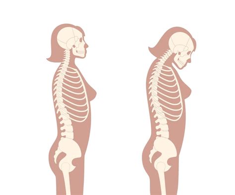 Premium Vector Neck Vertebrae Deformity