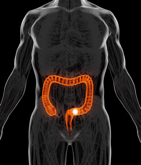 Colonic Polyps And Colon Cancer Treatment In India Desai Surgical