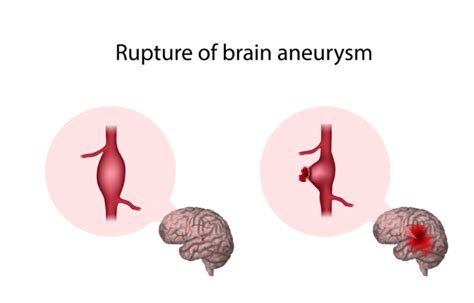 Early Warning Signs Of A Brain Aneurysm The Center Oregon