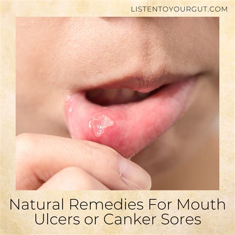 Oraswift All Natural Canker Sore Medicine And Mouth Sores Relief