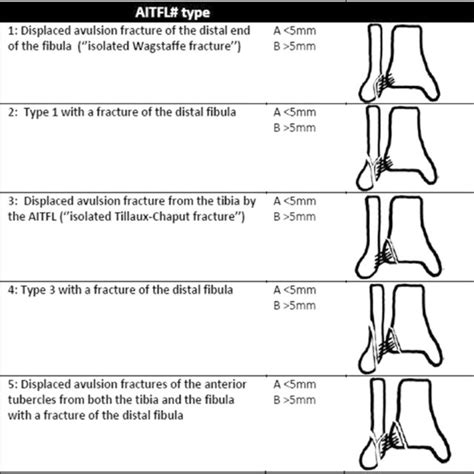 Pdf Anterior Inferior Tibiofibular Ligament Avulsion Fractures In Operatively Treated Ankle