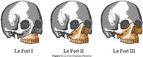 Lefort Fracture Iv