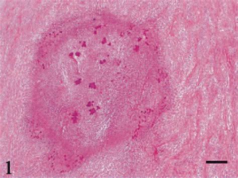 Granulation Tissue Histology