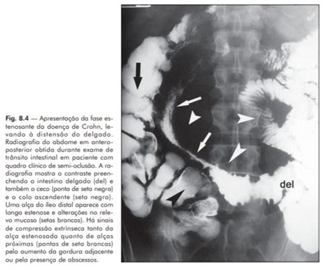 Obstrução Intestinal De Delgado Exames De Imagem