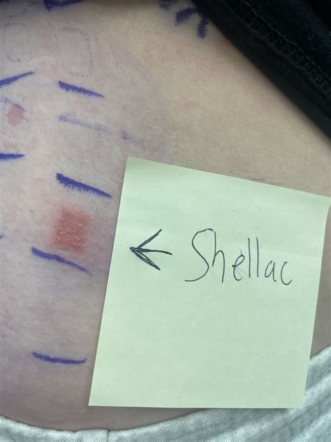 Walter Liszewski Md On Linkedin Today I Had A Patient With A 2